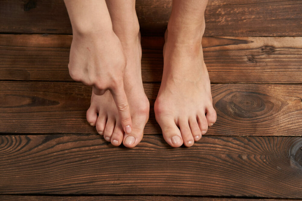 15 Best Ways To Treat Bunions Without Surgery
